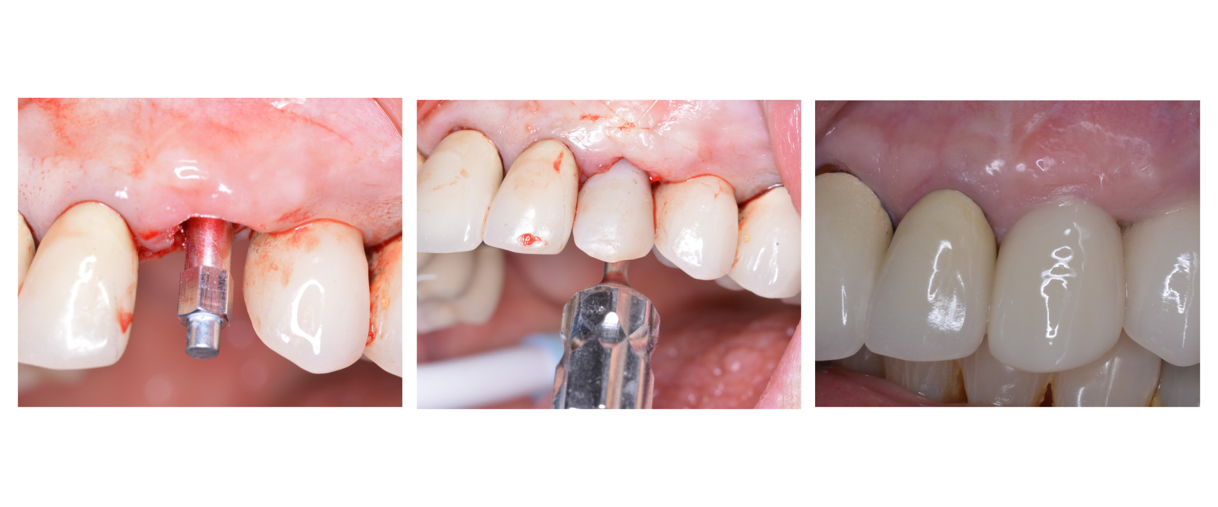 When To Immediately Load an Immediate Implant